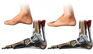 Arch Support for your Feet – Are they really needed?