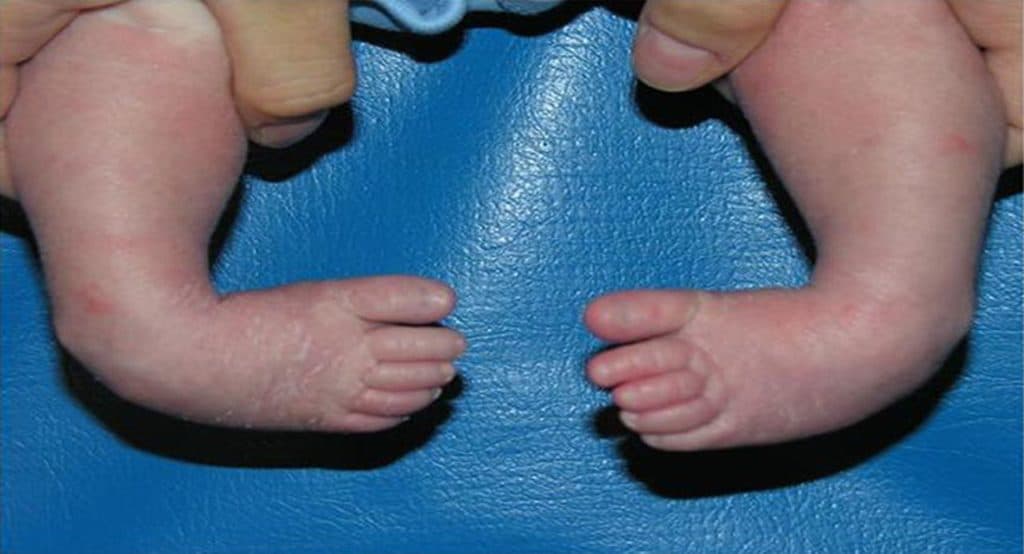 A Brief Discussion about Clubfoot - Causes and Treatment - MEDICAL ISLAND